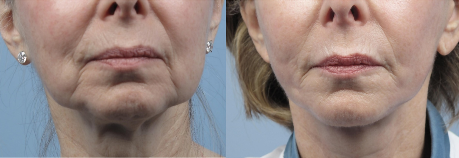 FaceTITE BodyTITE Morpheus8 Before-After Pics - ReGen Medical Clinic