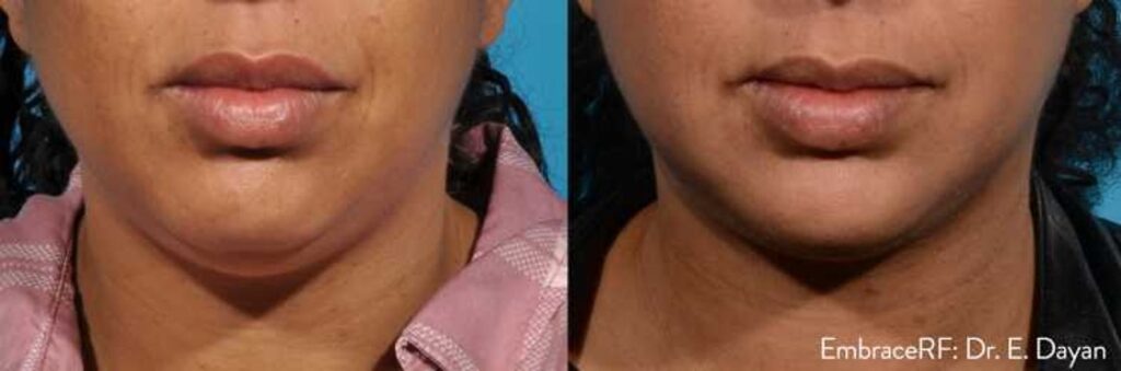 FaceTITE BodyTITE Morpheus8 Before-After Pics - ReGen Medical Clinic