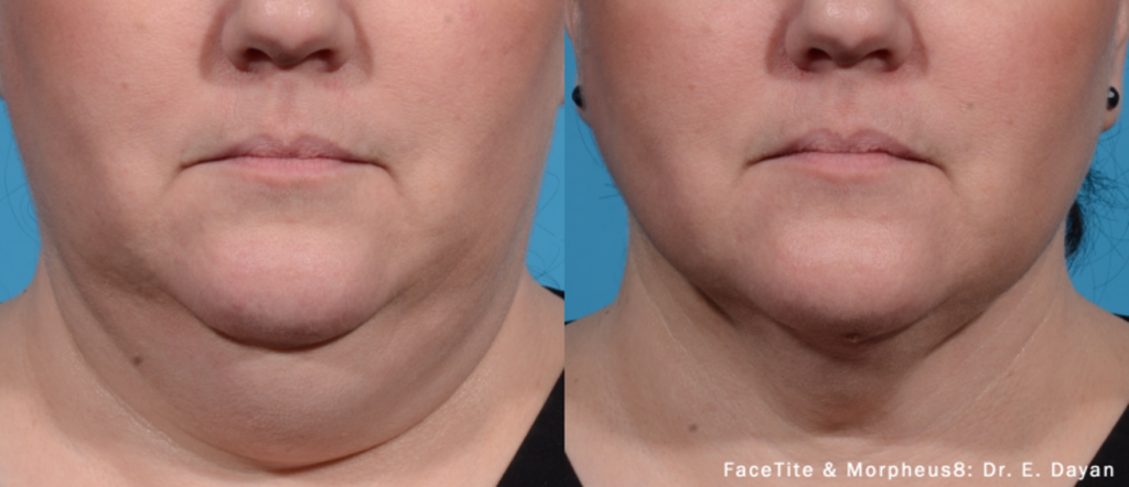 FaceTITE BodyTITE Morpheus8 Before-After Pics - ReGen Medical Clinic